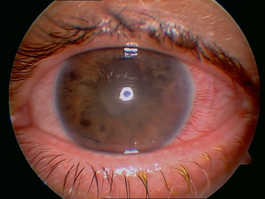 8 enfermedades que causan ceguera - Clínica Oftalmológica Madrid