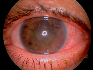 Tratamiento Erosión Corneal Recidivante | Ocumed